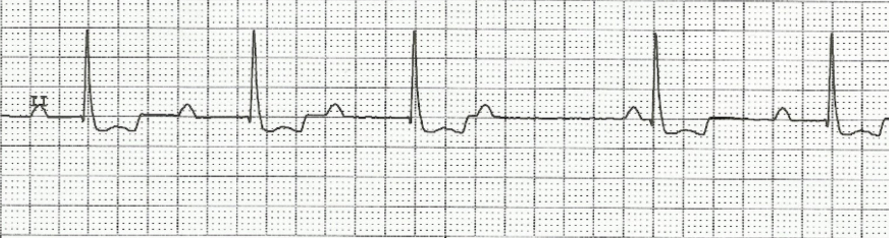 The PR interval can be described as: normal, | Chegg.com