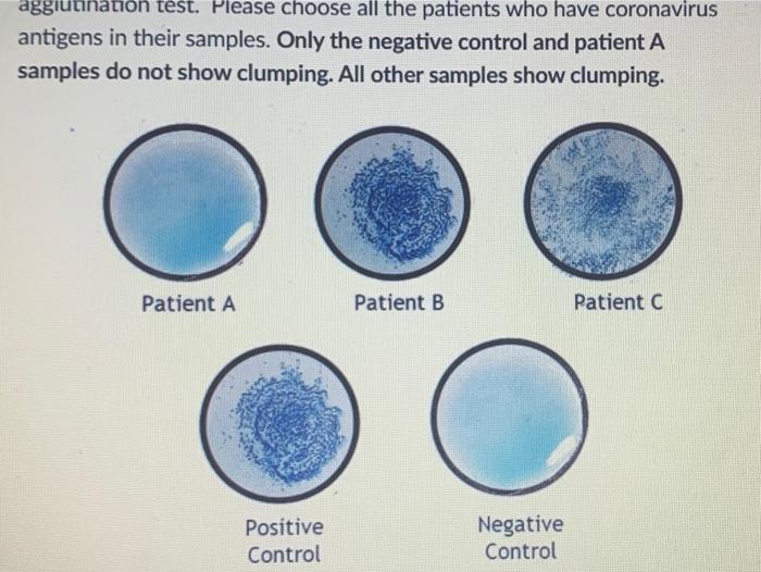 Solved agglutination test. Please choose all the patients | Chegg.com