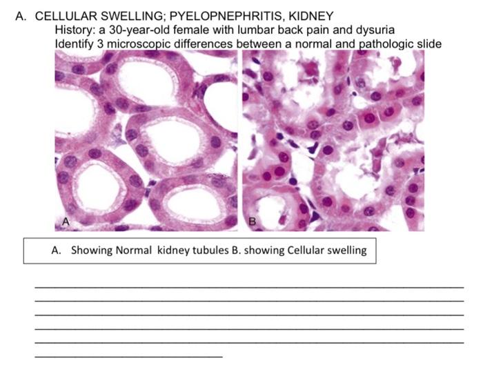 Solved A. CELLULAR SWELLING; PYELOPNEPHRITIS, KIDNEYHistory: | Chegg.com