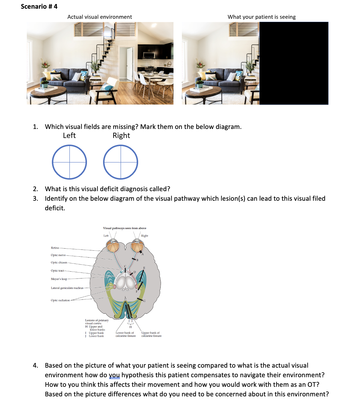 Solved Which visual fields are missing? Mark them on the | Chegg.com