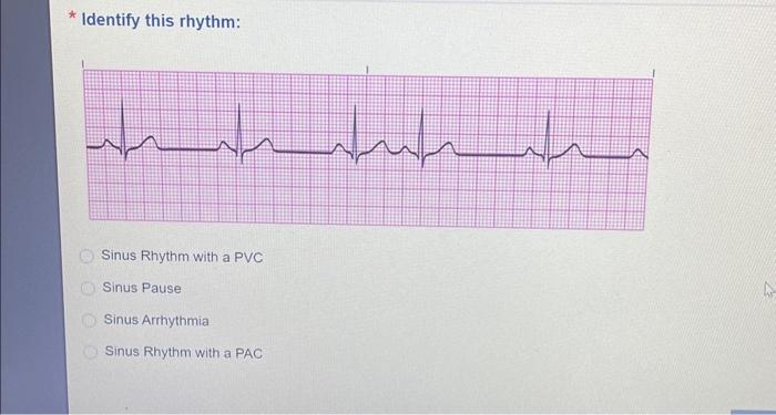 Solved Identify this rhythm: Sinus Rhythm with a PVC Sinus | Chegg.com