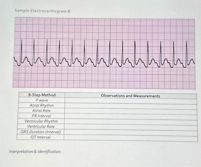 Solved Sample Electrocardiogram B Interpretation \& | Chegg.com