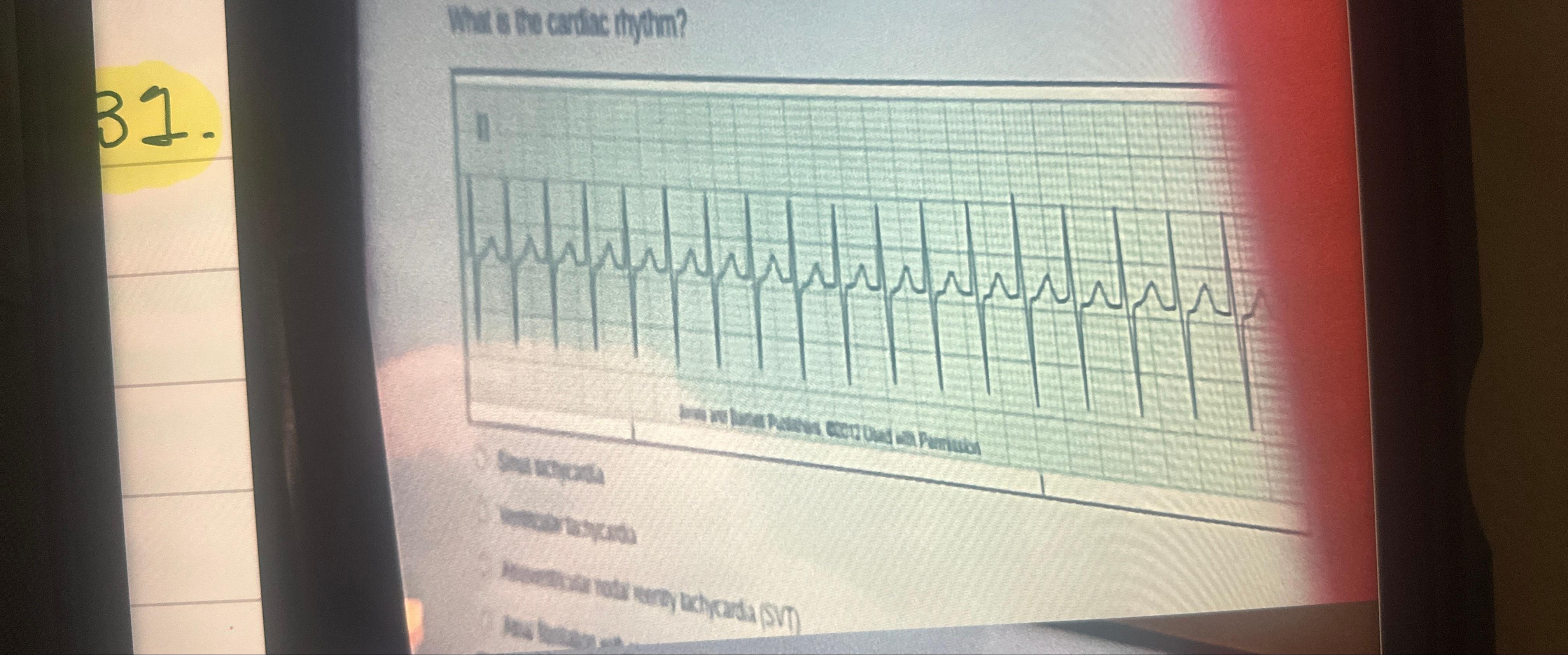 Solved What is the cardiac rhythm? ﻿Sinus tachycardia, | Chegg.com