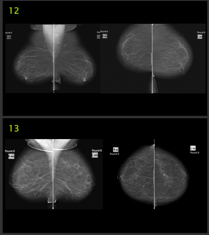 Solved the image below are mammography images please | Chegg.com