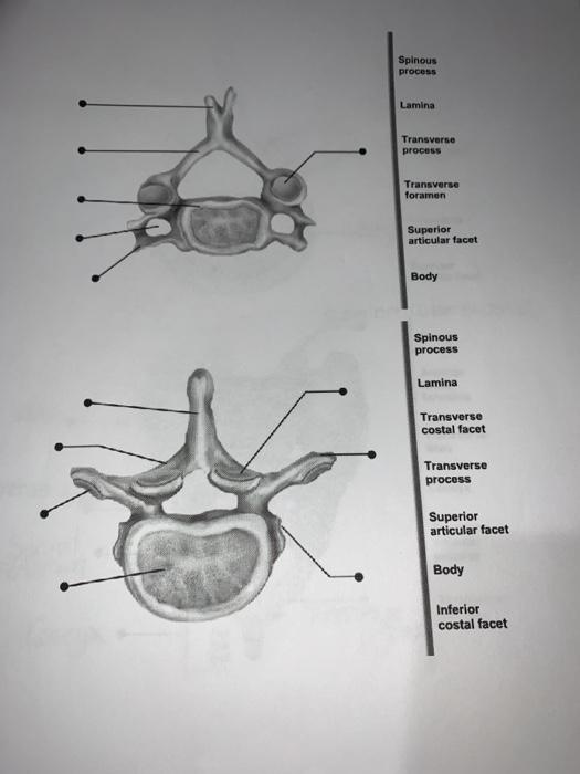 Solved Spinous process Lamina Transverse process Transverse | Chegg.com
