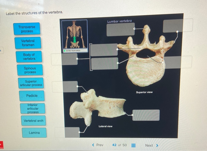 Solved Label the structures of the vertebra. Lumbar vertebra | Chegg.com
