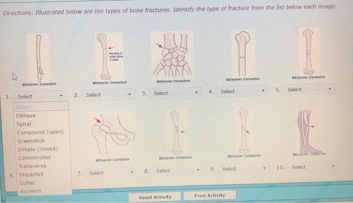 Solved Illustrated below or 10 types of bone fractures. | Chegg.com