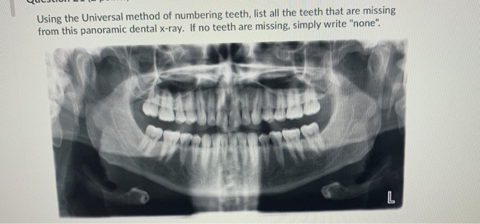 Solved Using the Universal method of numbering teeth, list | Chegg.com