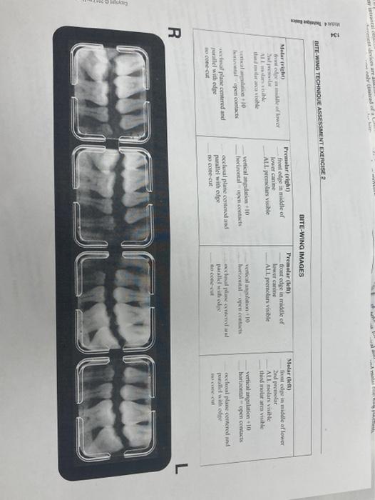wa devices are wa wo 134 BITE-WING TECHNIOUE | Chegg.com