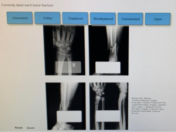Solved Correctly label each bone fracture. Greenstick Colles | Chegg.com