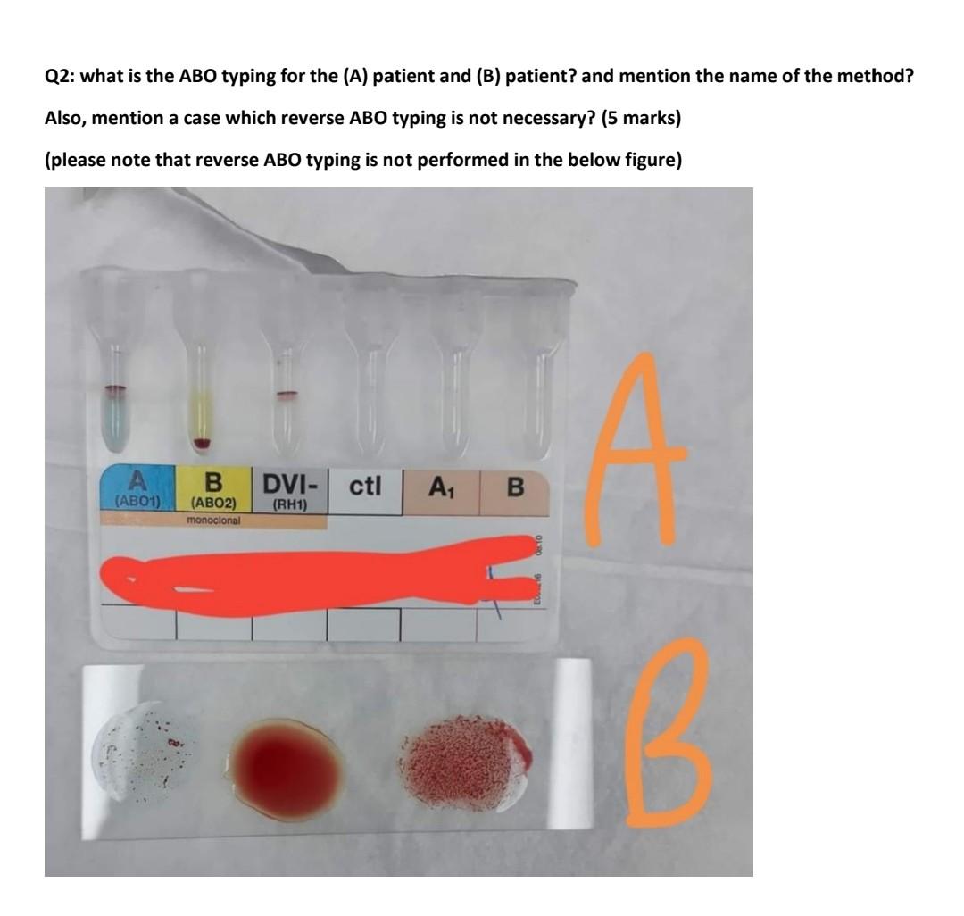 Solved Q3: a 33 years old male patient with O positive blood | Chegg.com