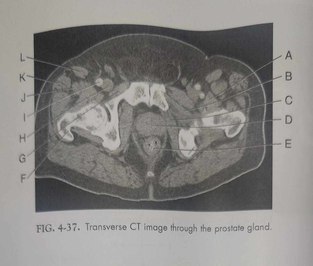 FIG. 4-37. Transverse CT image through the prostate | Chegg.com