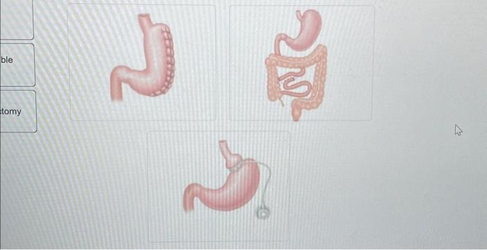 Solved label the following types of bariatric surgery. IIeal | Chegg.com
