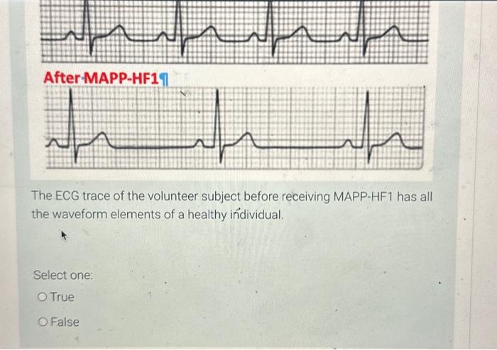 Solved The ECG trace of the volunteer subject after | Chegg.com