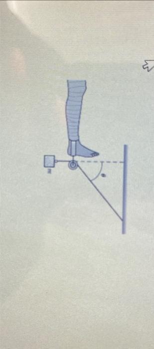 Solved Para mantener un hueso de la pierna roto en posición | Chegg.com