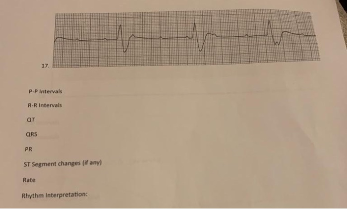 Solved P.P Intervals R-R Intervals QT QRS PR ST Segment | Chegg.com