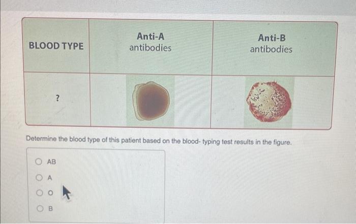 Solved Determine the blood type of this patient based on the | Chegg.com