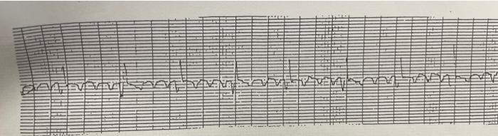 what is the AV ratio of the following ECG strip | Chegg.com