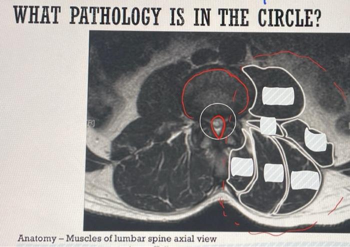 Solved WHAT PATHOLOGY IS IN THE CIRCLE? | Chegg.com