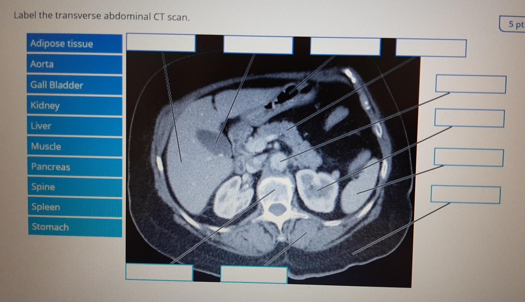 Solved Label the transverse abdominal CT scan. 5pt: Adipose | Chegg.com
