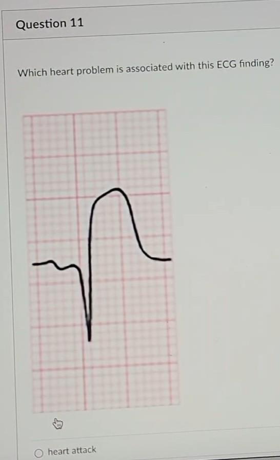 Solved Identify the ECG: heart block ventricular tachycardia | Chegg.com