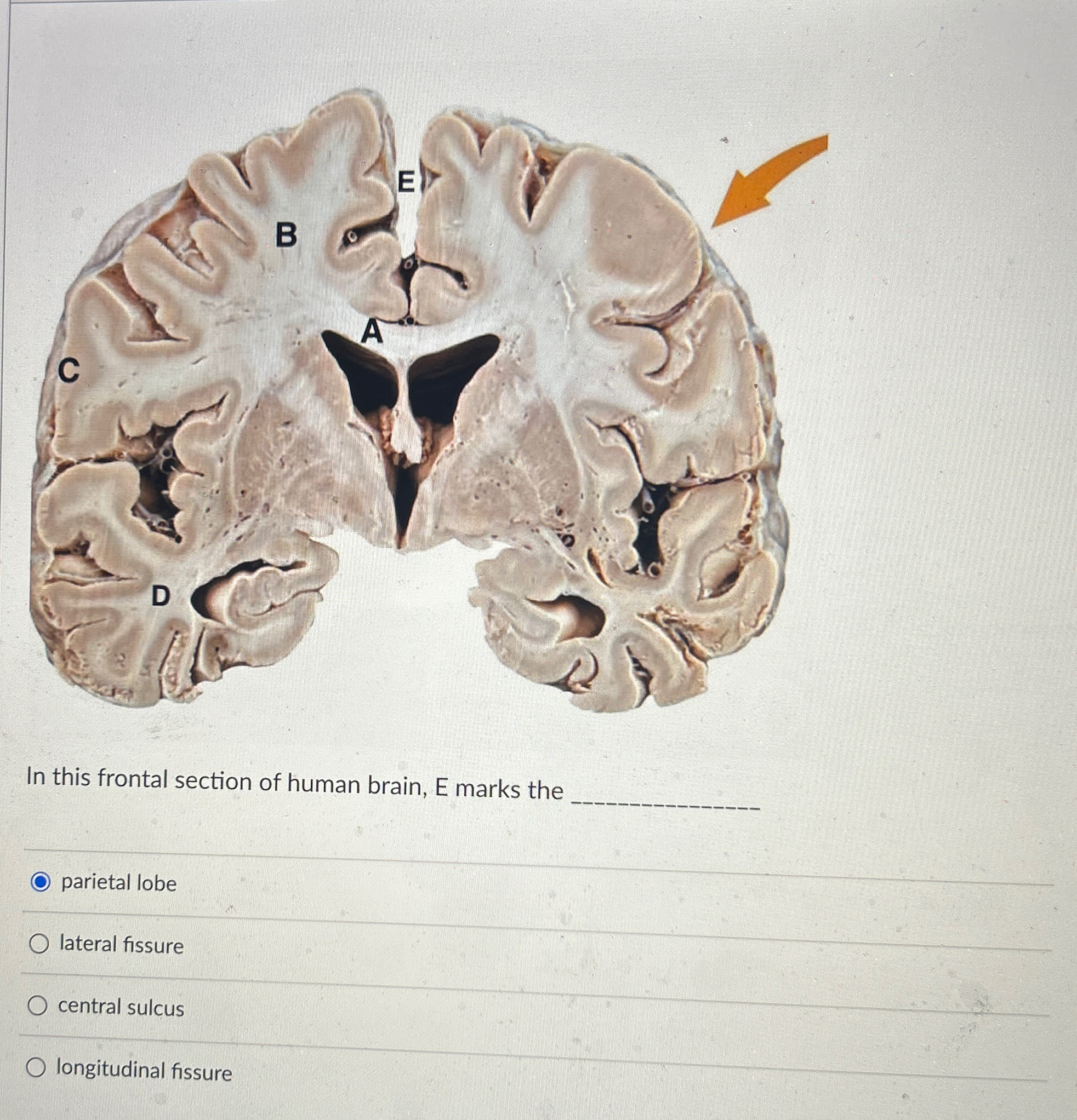 Solved In this frontal section of human brain, E marks | Chegg.com