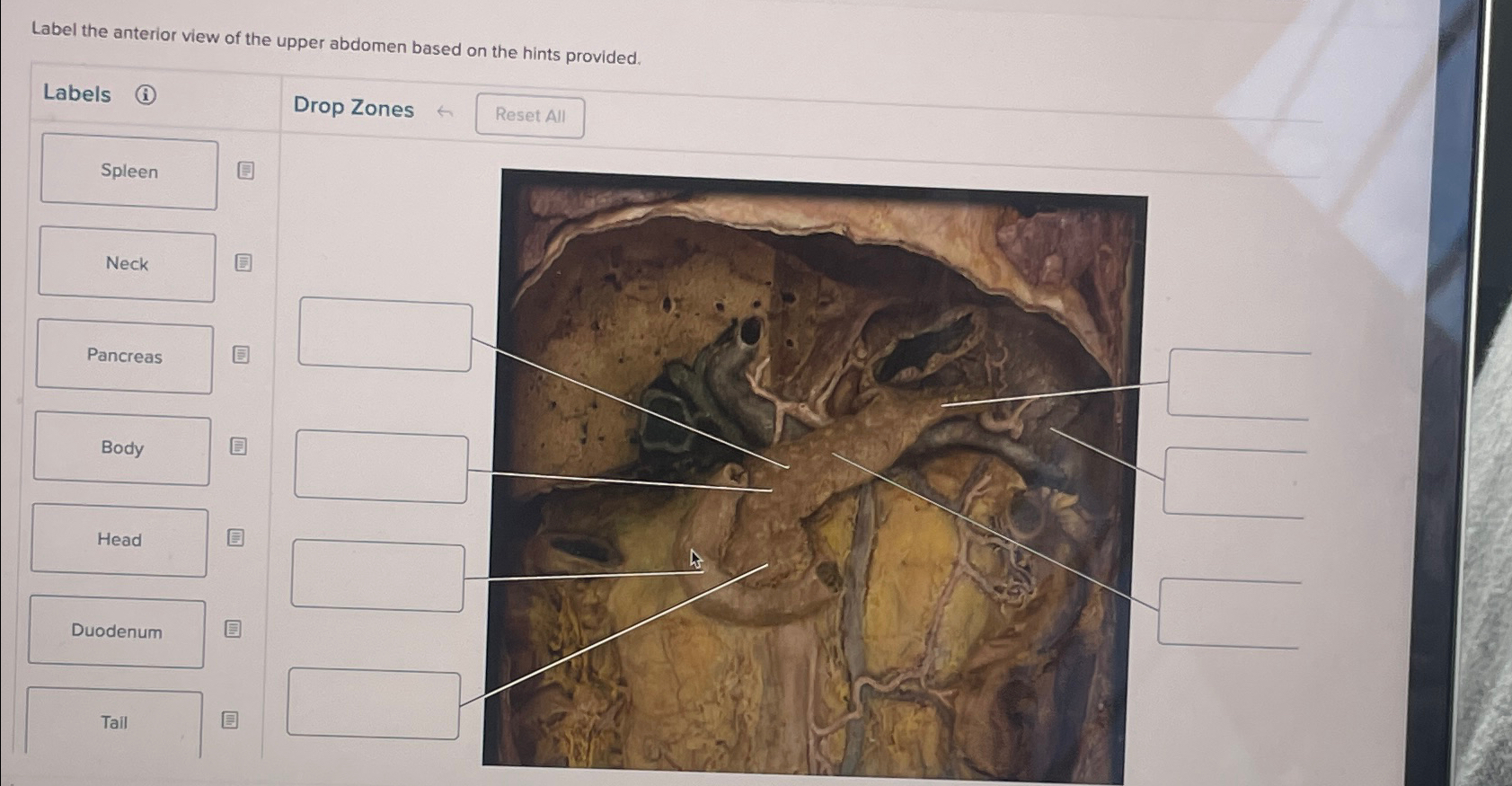 Solved Label the anterior view of the upper abdomen based on | Chegg.com