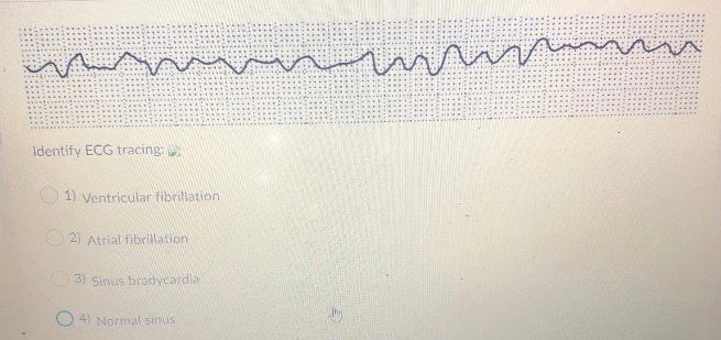 Solved mm Identify ECG tracing 1) Ventricular fibrillation | Chegg.com