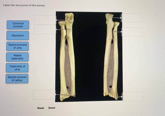 Solved Label the structures of the bones. Coronoid process | Chegg.com