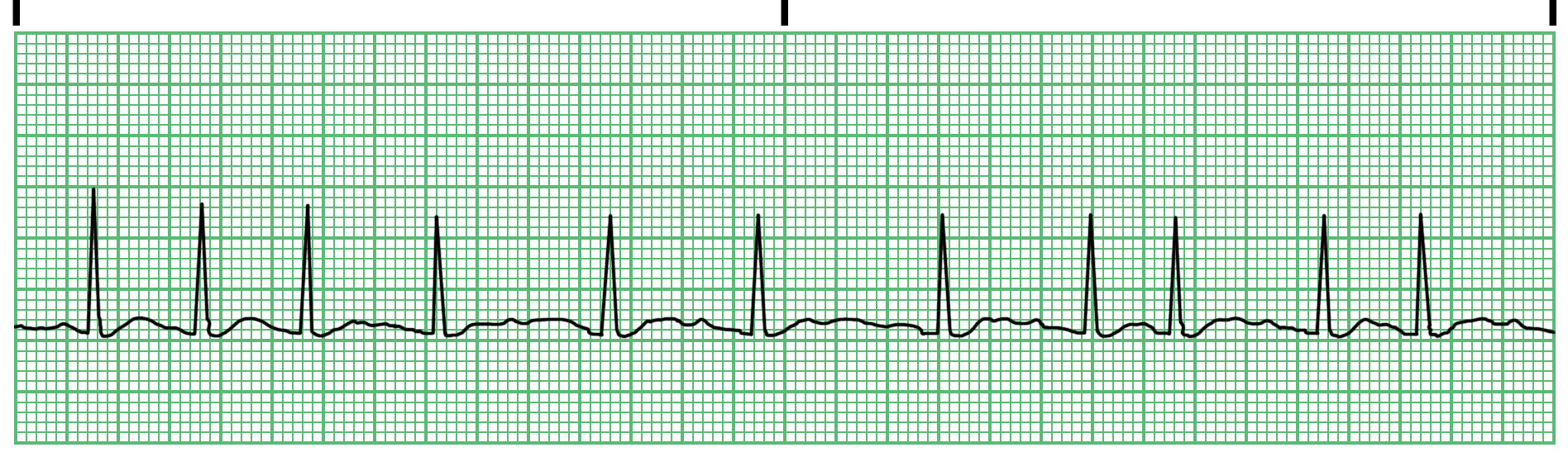 Solved what cardiac rhythm is shown? afib, aflutter, NSR | Chegg.com