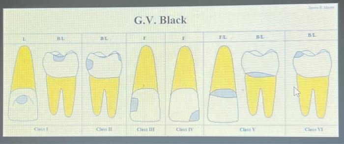 Solved G.V. Black Tooth \# 1: Class Surfaces:MO Tooth \# 2: | Chegg.com