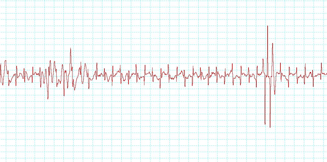 Solved Mitral Area: Describe the shape of the S1 ﻿& S2 | Chegg.com