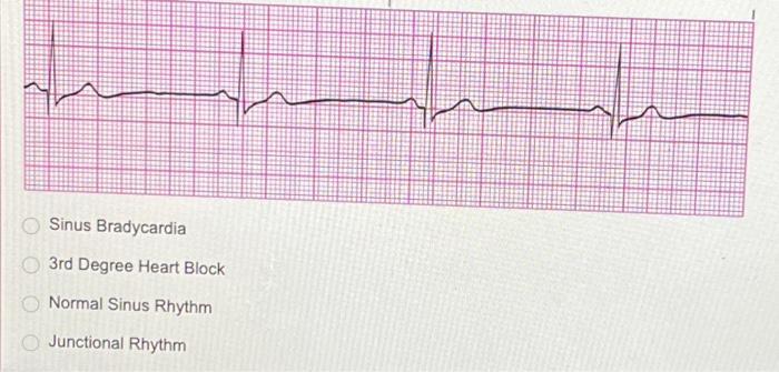 Solved 2nd Degree Heart Block Type 1 Sinus Bradycardia | Chegg.com
