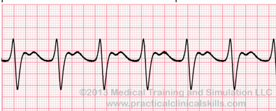 Solved ___ ﻿Normal P wave ﻿ _X_ ﻿Inverted P wave ﻿ __ | Chegg.com