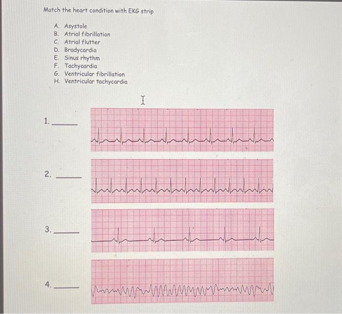 Solved Match the heart condition with EKG strip A Asystole | Chegg.com