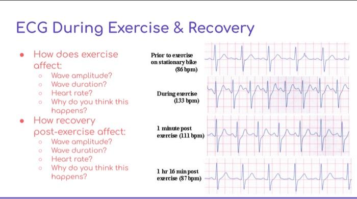 ECG During Exercise \& Recovery | Chegg.com