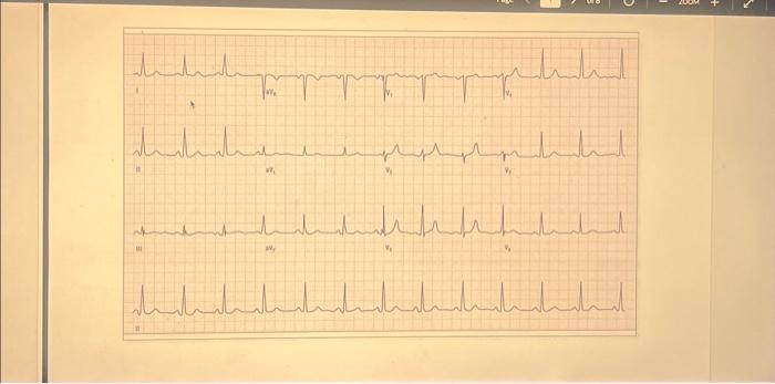 Solved Can anyone help me interpret this ECG and any | Chegg.com