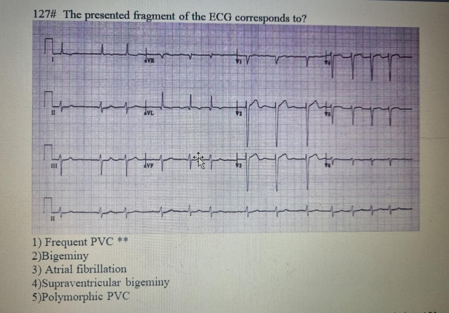 Solved 126\# The presented fragment of the ECG corresponds | Chegg.com