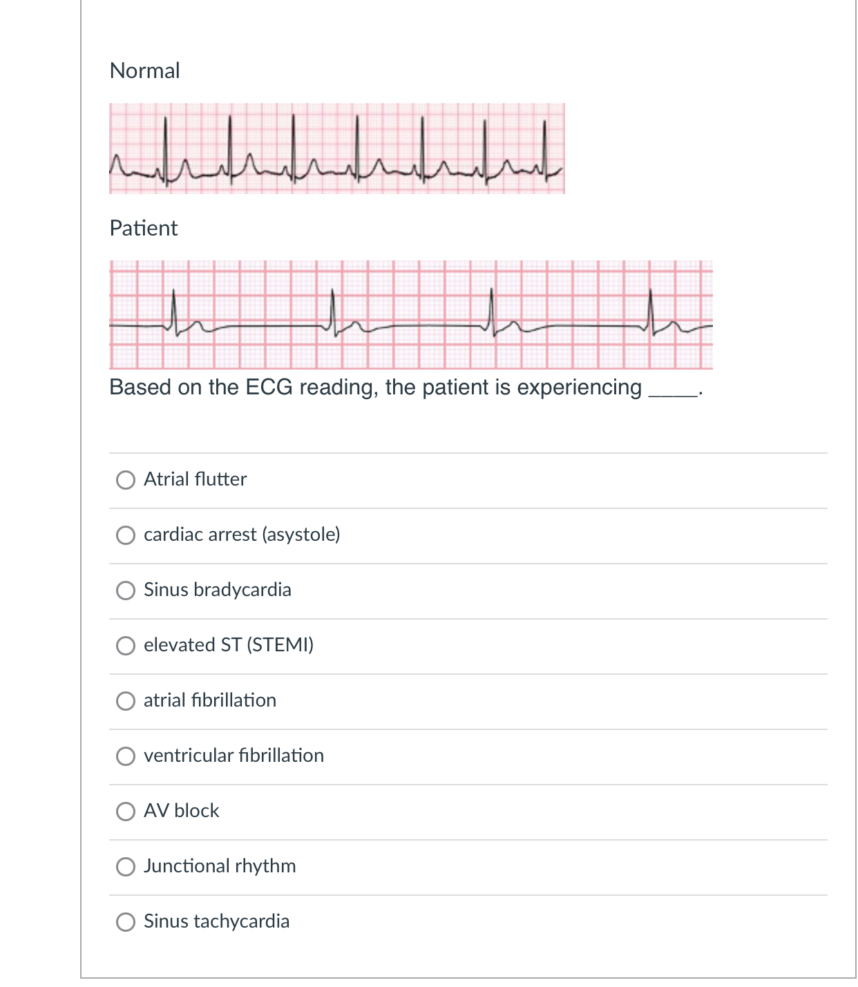 Solved Normal Question 25NormalPatientBased on the ECG | Chegg.com