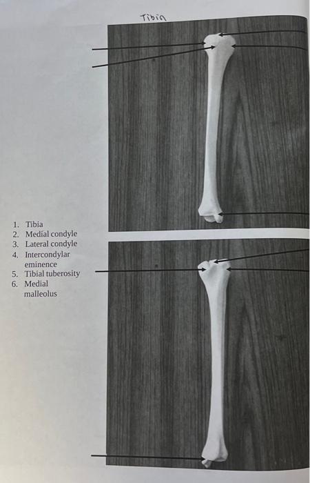 Solved 1. Tibia 2. Medial condyle 3. Lateral condyle 4. | Chegg.com