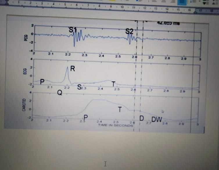 Solved The files pecl.dat, Pecl PCG ECG CP, and Pec2_PCG ECG | Chegg.com