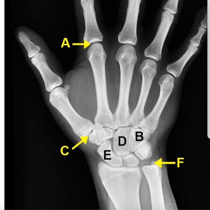 Solved From the hand x-ray above: Identify joint A: Identify | Chegg.com