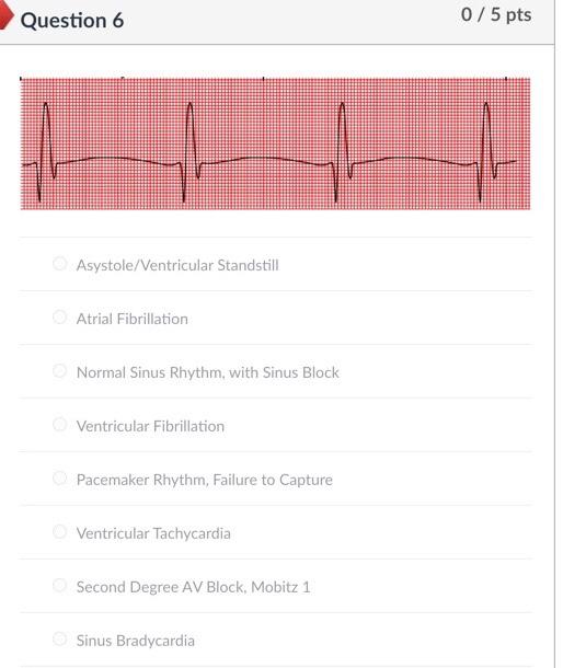 Solved Question 2 0/5 pts Asystole/Ventricular Standstill | Chegg.com