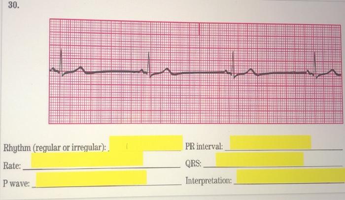 Solved 30. Rhythm (regular or irregular): PR interval: QRS: | Chegg.com