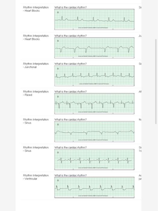 Solved What is the coach? Rhythm interpretation Heart Blocks | Chegg.com