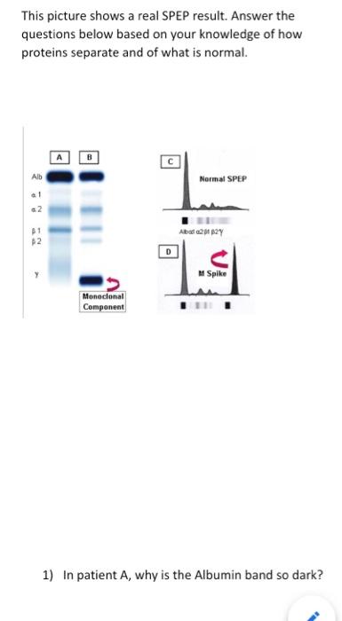 Solved This picture shows a real SPEP result. Answer the | Chegg.com