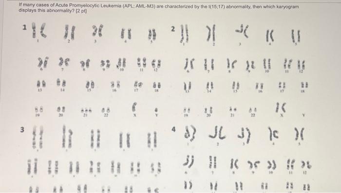 Solved if many cases of Acute Promyelocytic Leukemia | Chegg.com