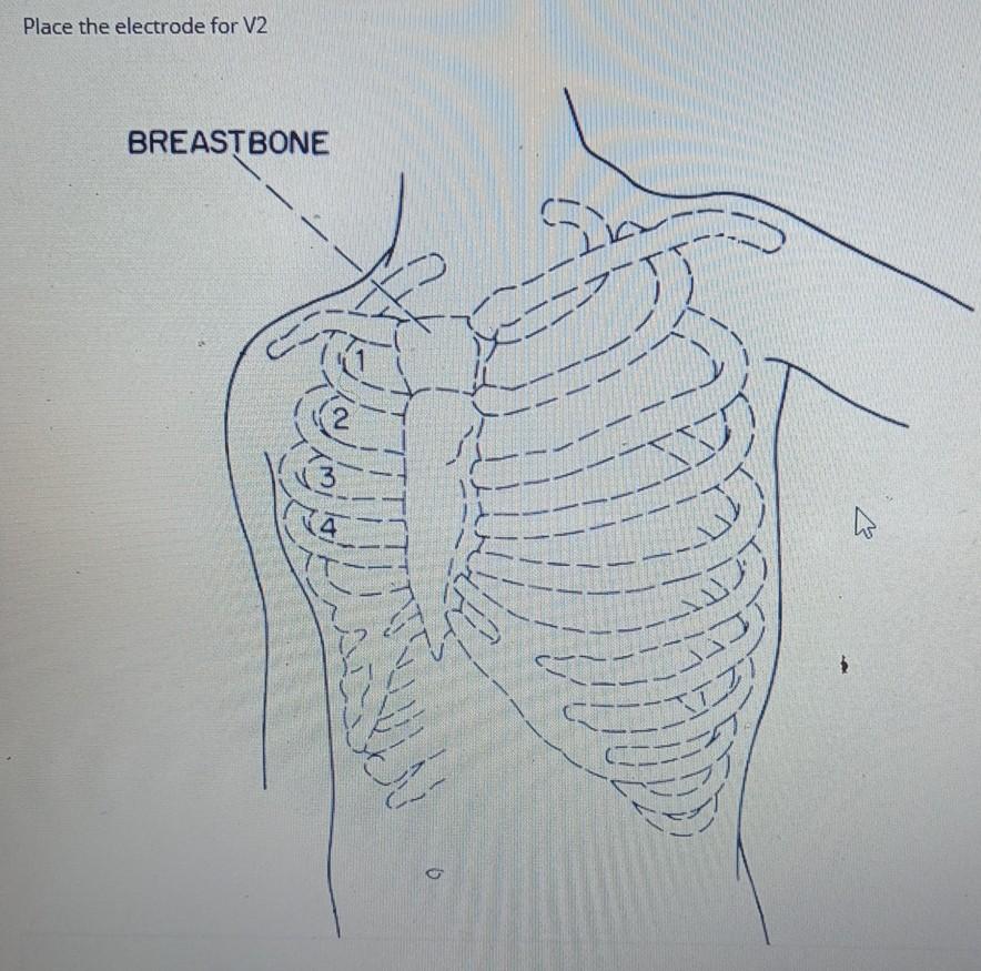 Solved Place the electrode for V2 BREASTBONE a T 피 | Chegg.com