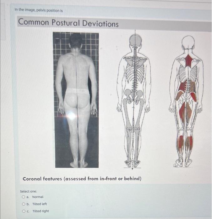 Solved Common Postural Deviations Coronal features (assessed | Chegg.com