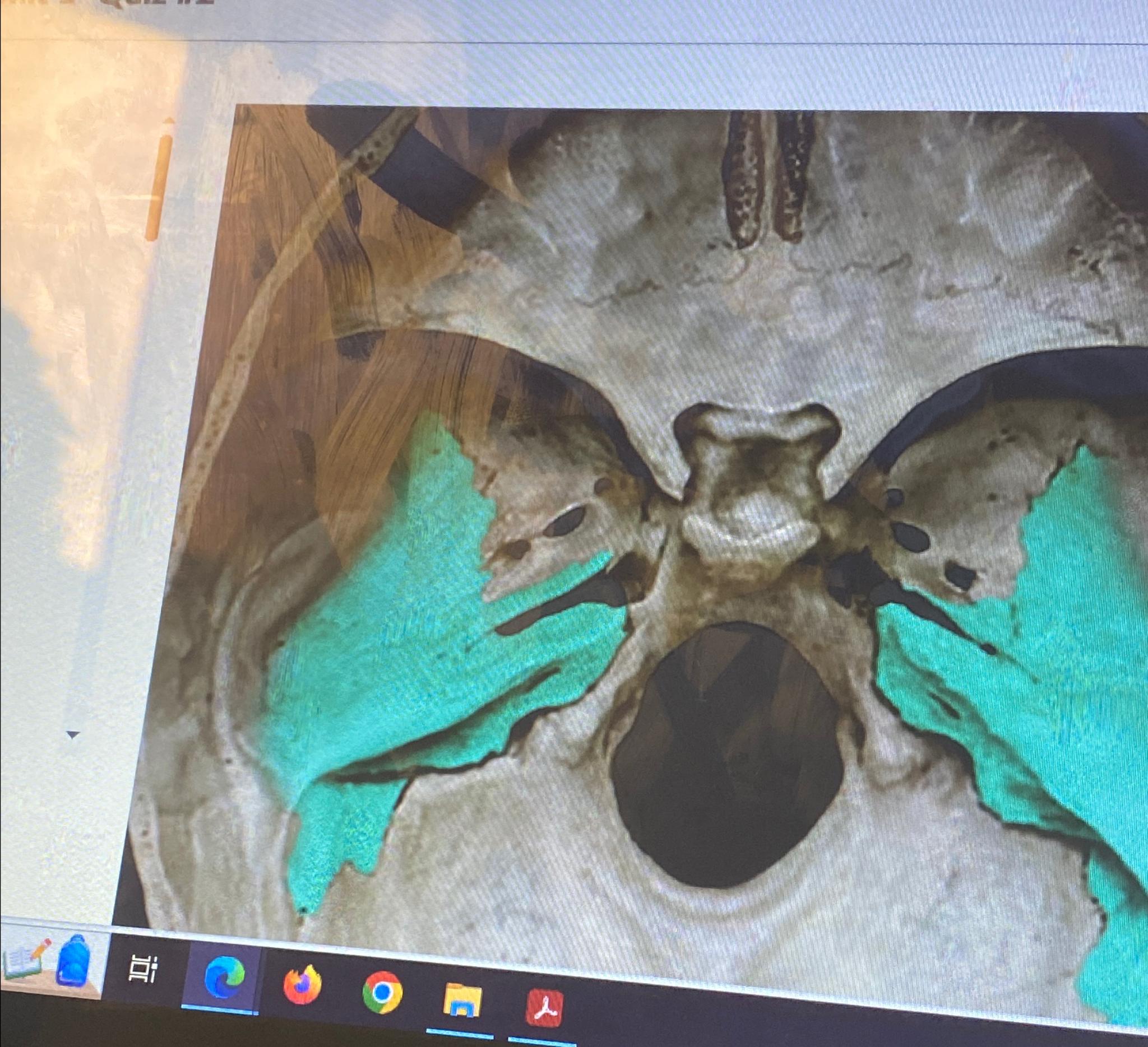 Solved Identify the highlighted bone structure | Chegg.com